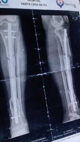 Protese perna esquerda | Vaquinhas online