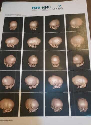 Cirurgia do Hendrew Silva (ESCAFOCEFALIA TARDIA) | Vaquinhas online