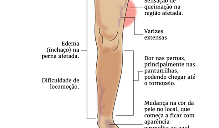 Ajude a Selma a conseguir operar de Flebite e Trombose | Vaquinhas online