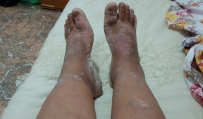 Erika , para pernas inchada | Vaquinhas online