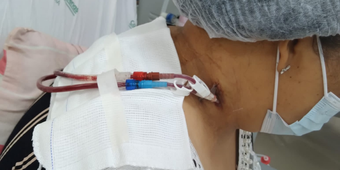 Implante de Catéter Permcath para Silvana | Vaquinhas online