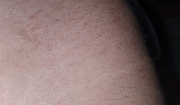 Cirurgia de remoção de haste intrafemoral | Vaquinhas online