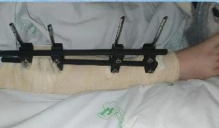 Ajuda para uma cirurgia de colocação de haste intramedular na tíbia ...