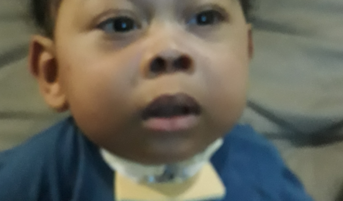 Tratamento para holoprosencefalia lobar | Vaquinhas online