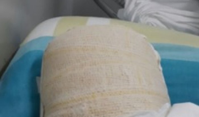 Prótese Perna Esquerda | Vaquinhas online