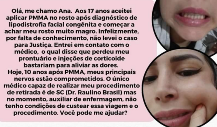 REMOÇÃO DE PMMA DA FACE, CIRURGIA REPARADORA | Vaquinhas online