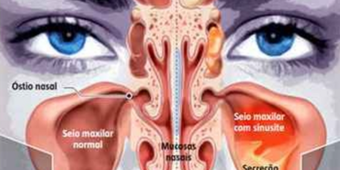 Cirurgia de Sinusite com urgência!!!! | Vaquinhas online