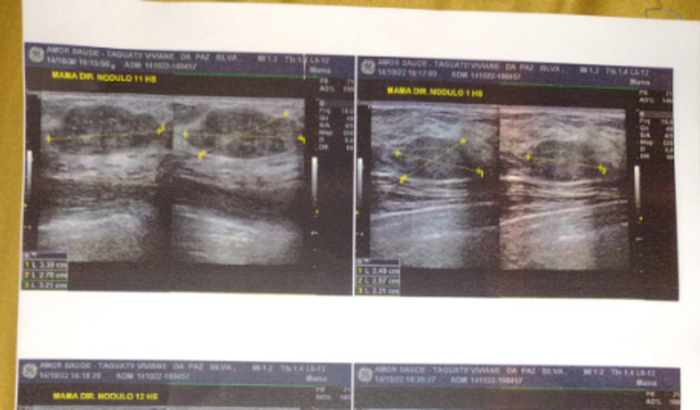 Cirurgia de retirada de nódulos nos seios | Vaquinhas online