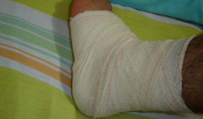 Cirurgia no tornozelo | Vaquinhas online