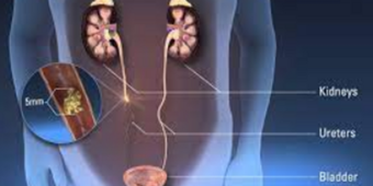 cirurgia de ureterorrenolitotripsia flexivel para a remoção de um ...