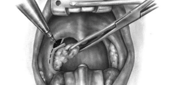Ajuda para cirurgia de retirada das Amígdalas | Vaquinhas online