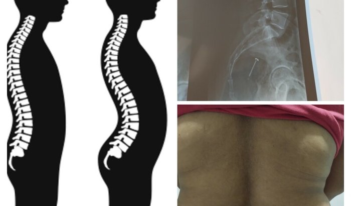 Hiperlordose lombar | Vaquinhas online