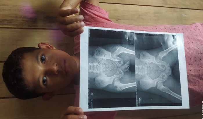 Prá ajudar no tratamento do meu filho que tem necrose vascola no femio ...