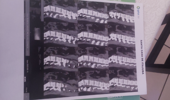 Ajuda cirurgia de urgência na coluna da Bianca. | Vaquinhas online