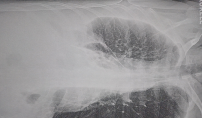 Ajuda para o tratamento de derrame pleural | Vaquinhas online