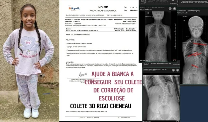 Ajude a Bianca a conseguir seu colete de correção de ESCOLIOSE ...