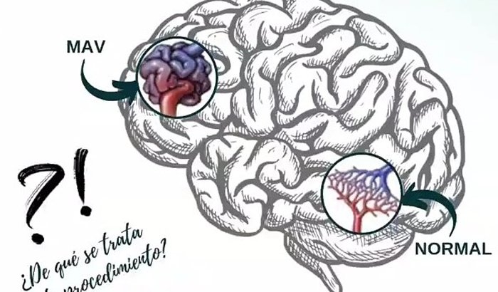 CIRURGIA DE MAV CEREBRAL | Vaquinhas online
